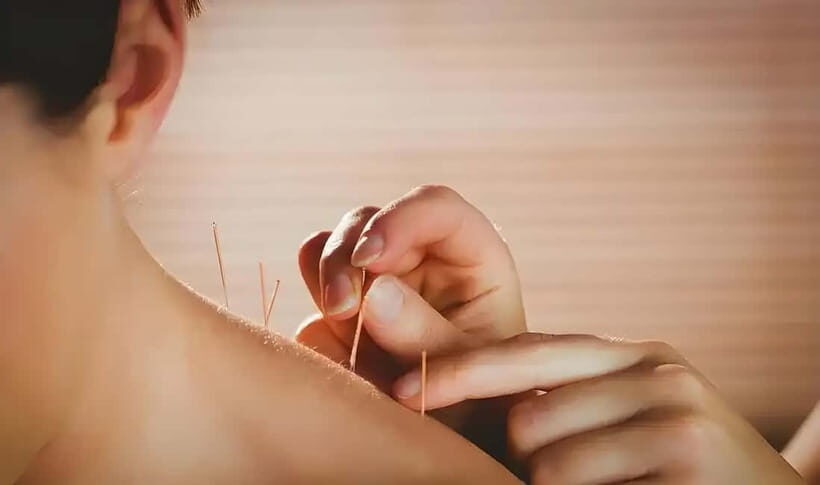 Shenzhen: Acupuncture Experience with TCM Practitioner - What to Expect on the Day