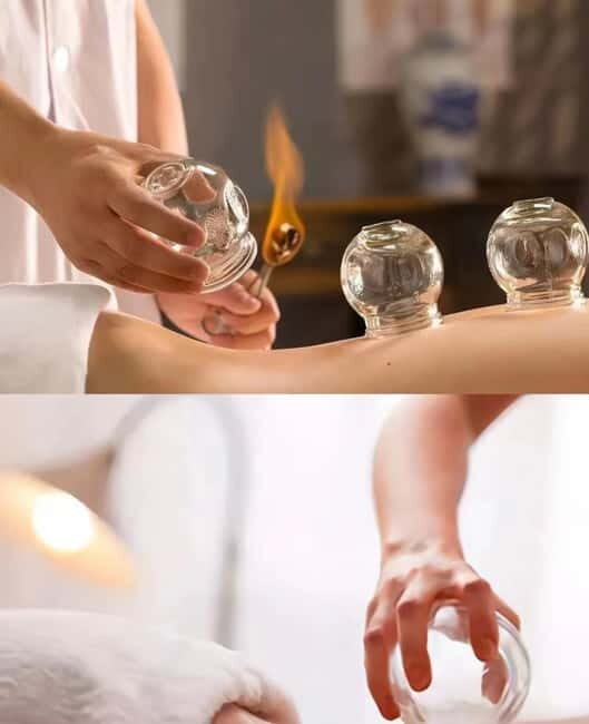 Shanghai: Chinese Medicine Acupuncture and Cupping Session - The Value of Authentic Chinese Medicine