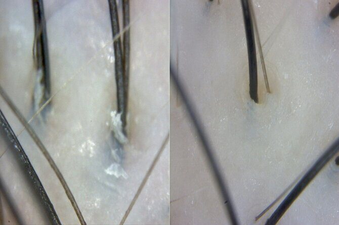 15 Step Stem Cell Scalp Treatment in Seoul - An In-Depth Look at the 15-Step Treatment Experience